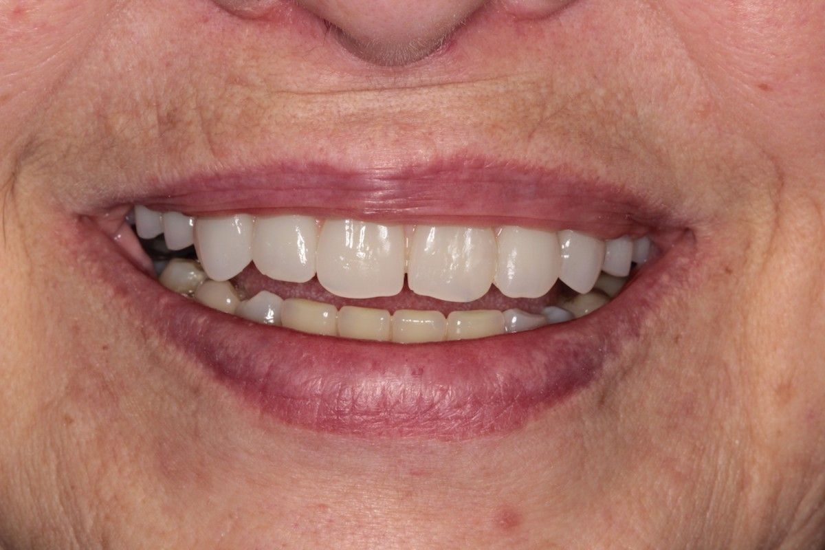 Casi clinici - Dentista Galatina (Lecce) - Studio Dentistico Lagna